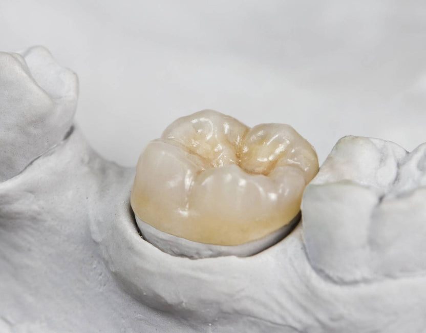 PFM Crown Prep in a Digital Workflow: A Practical Guide for Predictabl ...